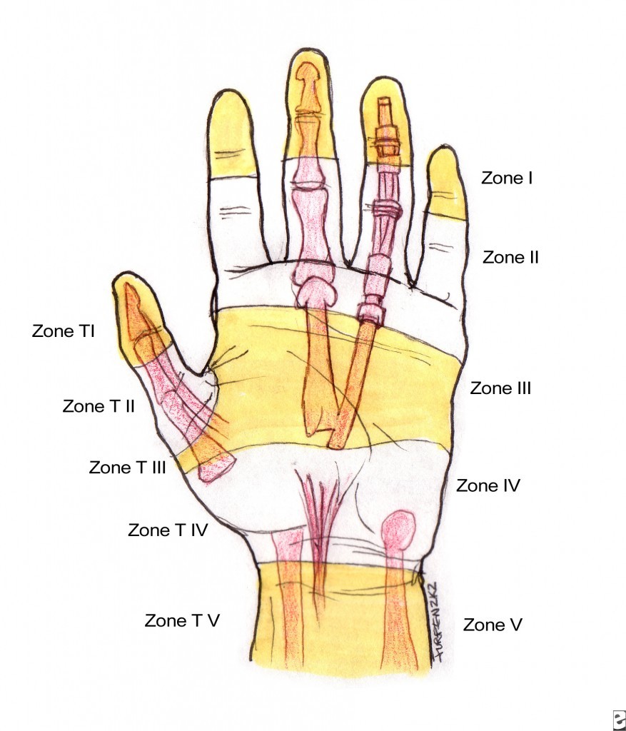 Common Flexor Tendon Common Flexor Tendon